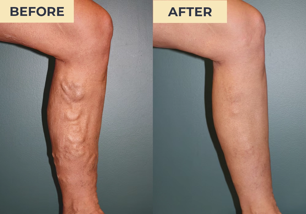 Treatment for Varicose Veins & Venous Ulcers | Jersey Shore Surgery ...