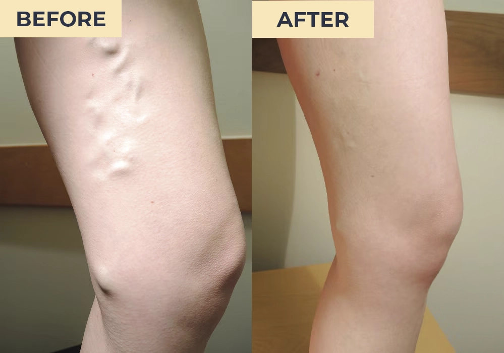 Treatment for Varicose Veins & Venous Ulcers | Jersey Shore Surgery ...