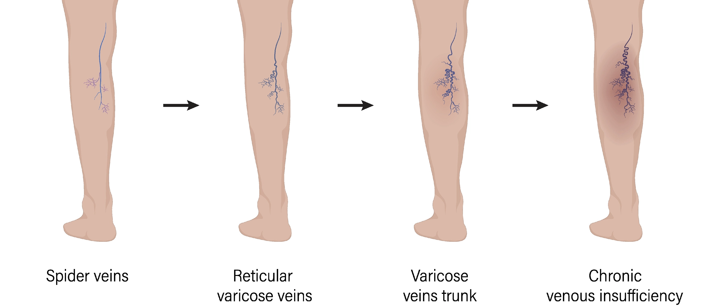 Treatment for Varicose Veins & Venous Ulcers | Jersey Shore Surgery ...